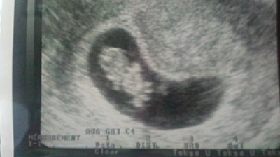 8W5D つわりと受診日（エコー画像あり） | みかんのこうのとり探しブログ - 楽天ブログ