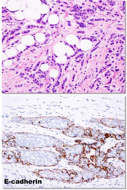 Infiltrating lobular carcinoma | 病理検査の玉手箱 - 楽天ブログ