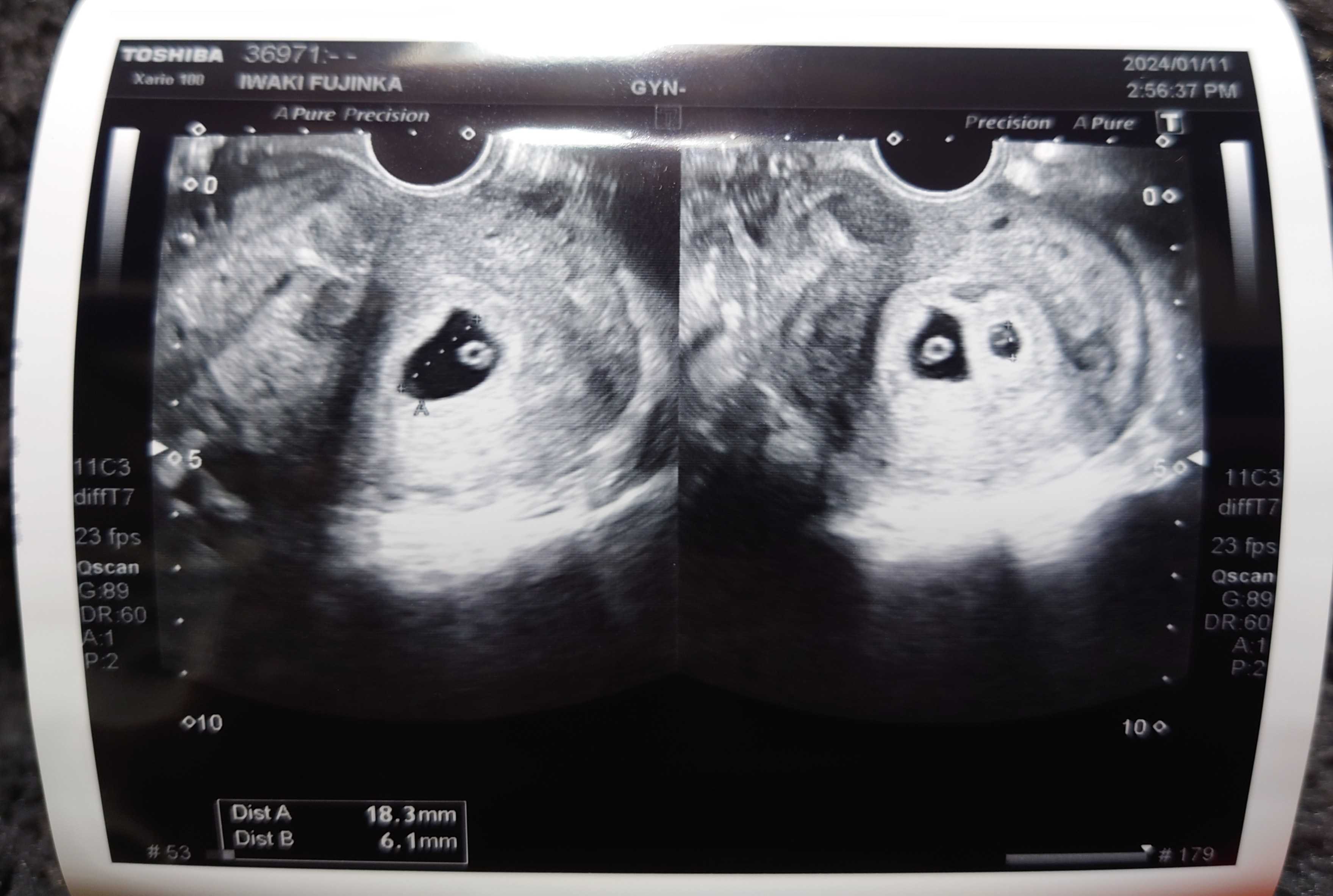 BT23、6w0d、胎嚢確認当日、出血。心拍確認！いまのところ双子！ | 卵管両側閉塞。体外受精！いわきのあらふぉー妊活！ノンストレス9年生活も自然妊娠至らず。凍結胚盤胞残2個！ - 楽天ブログ