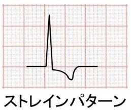 心電図のストレイン型、ストレインパターンとは | 循環器内科 - 楽天ブログ