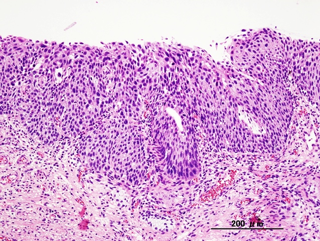 CINからLSIL, HSILの2段階分類法への移行 | 病理検査の玉手箱 - 楽天ブログ