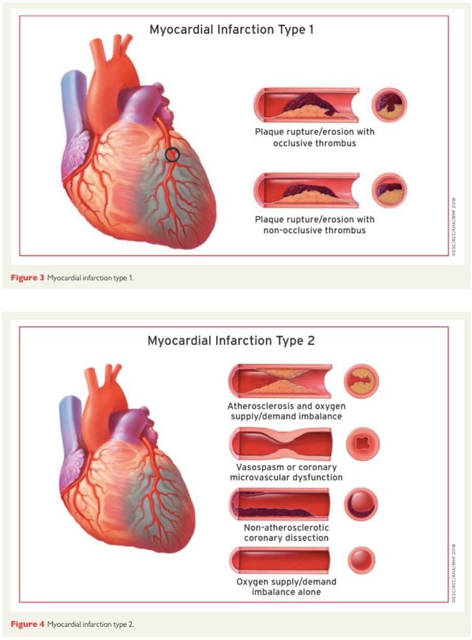 Emerging Diagnostic Methods for Myocardial Infarction Disease ...