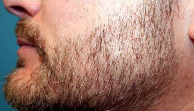 Facial Follicles: Understanding the Dynamics of Beard Hair Growth in ...