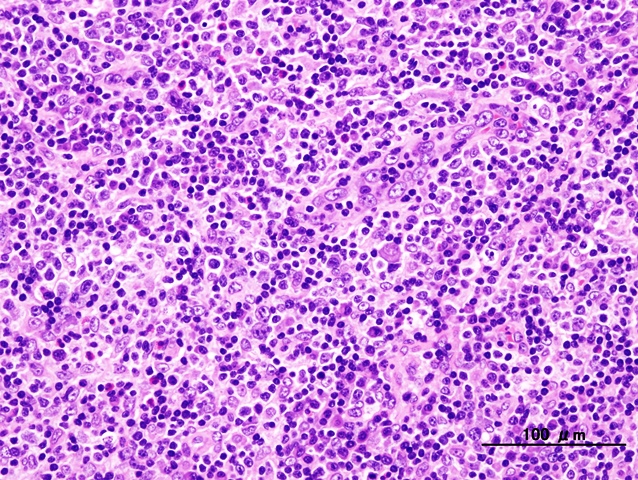 Angioimmunoblastic T-cell lymphoma (AITL) | 病理検査の玉手箱 - 楽天ブログ