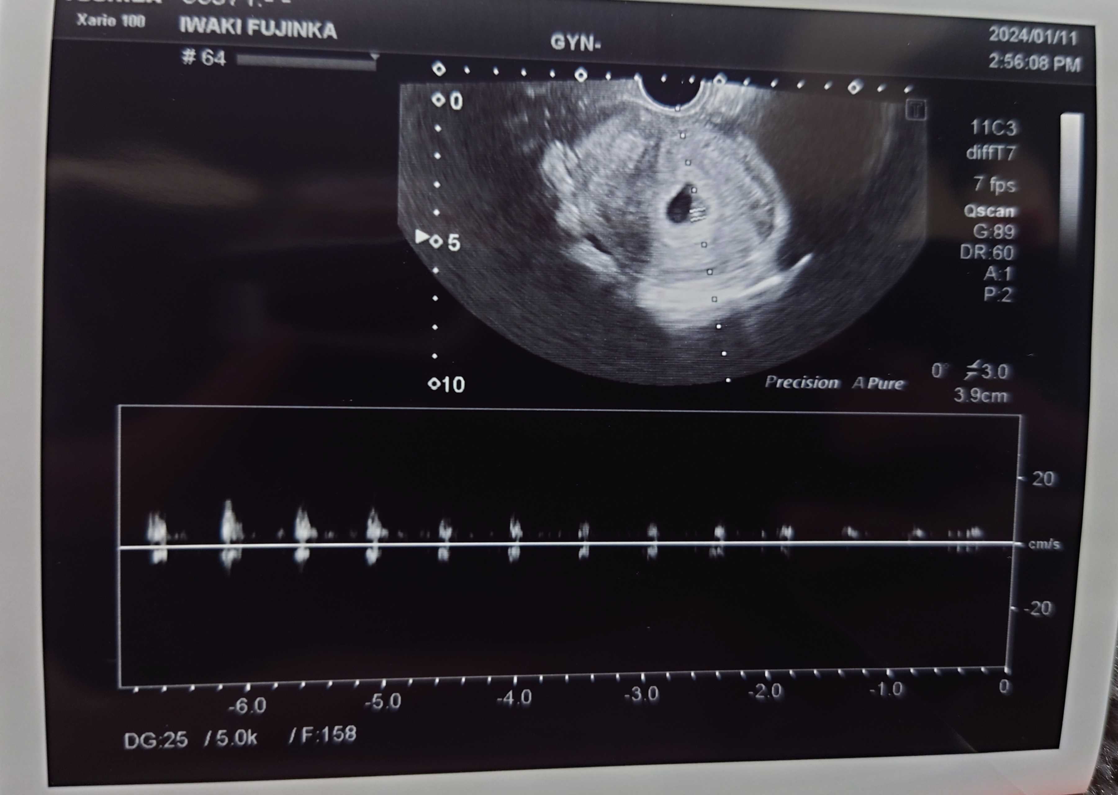 BT23、6w0d、胎嚢確認当日、出血。心拍確認！いまのところ双子！ | 卵管両側閉塞。体外受精！いわきのあらふぉー妊活！ノンストレス9年生活も自然妊娠至らず。凍結胚盤胞残2個！ - 楽天ブログ