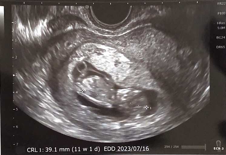 11w5d 初妊婦健診 | 23歳、多嚢胞生卵巣症候群だけど目指せママ！ - 楽天ブログ