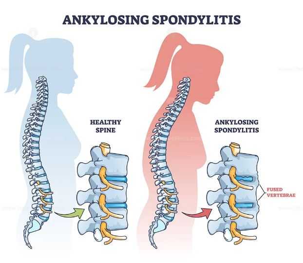 Ankylosing Spondylitis: A Comprehensive Review of Diagnosis and ...