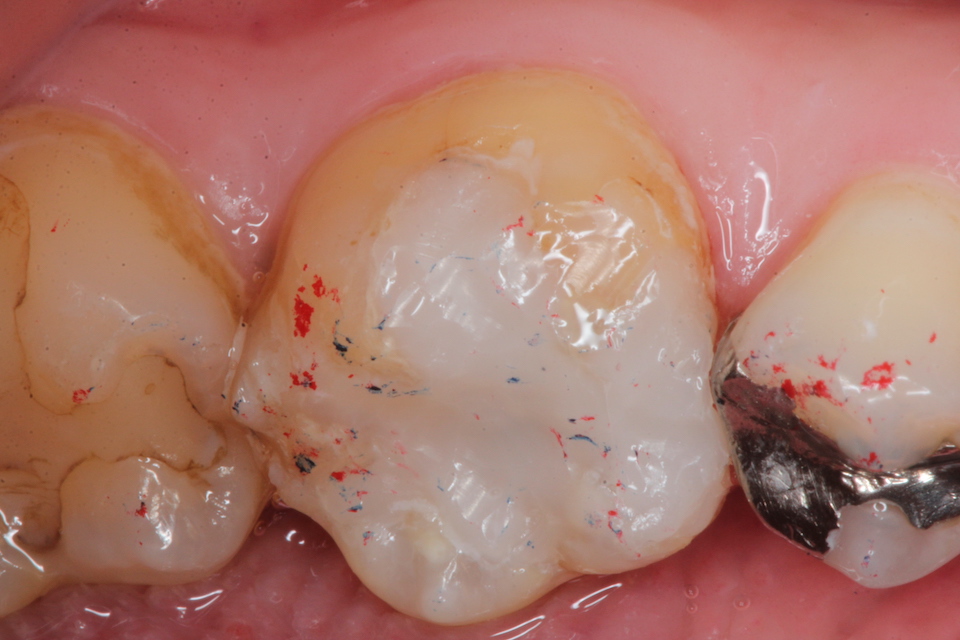 ストリップスを使わない隣接面CR6.5（メタルインレー脱離） | I歯科医院の高楊枝通信。 - 楽天ブログ