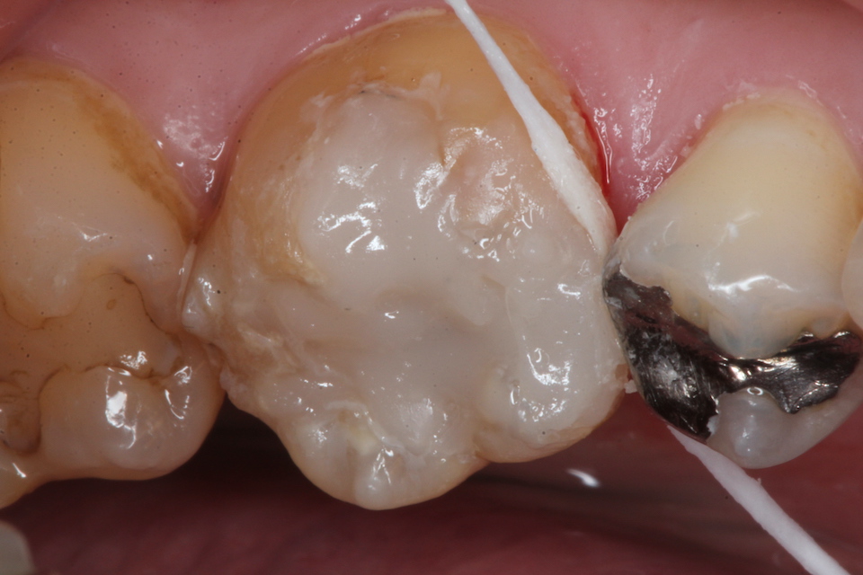 ストリップスを使わない隣接面CR6.5（メタルインレー脱離） | I歯科医院の高楊枝通信。 - 楽天ブログ
